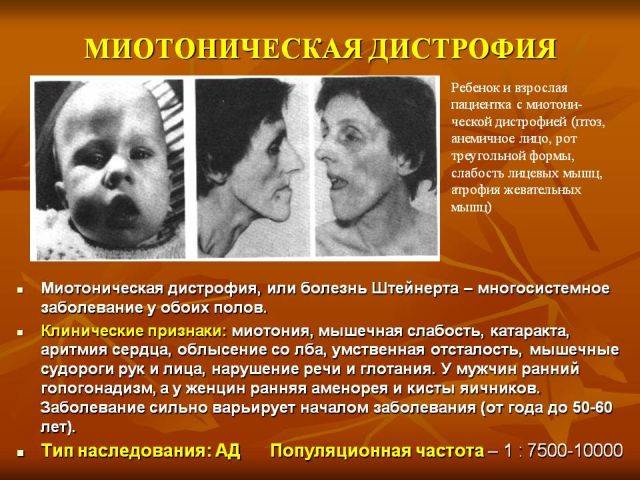 Dystrophic myotonia Rossolimo-Steinert-Kurshman - signs, causes ...