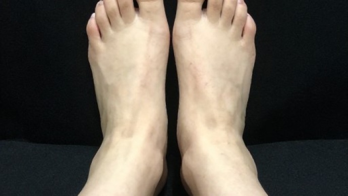 Clonus: causes, symptoms, diagnosis, treatment and prognosis. What are ...
